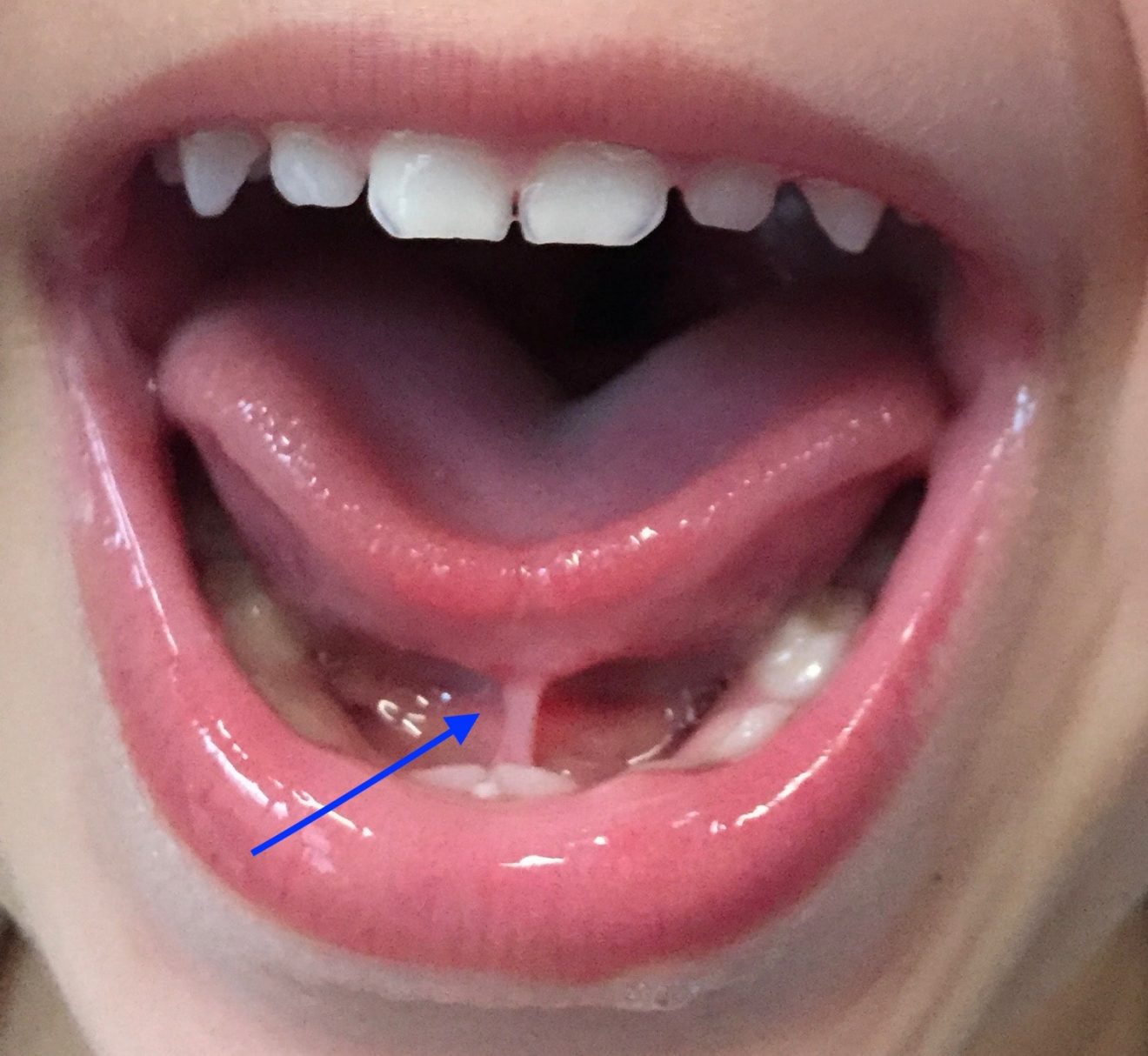 What Is A Tongue Tie And It s Causes Health2Wellness What Is A Tongue Tie And It s Causes Health2Wellness